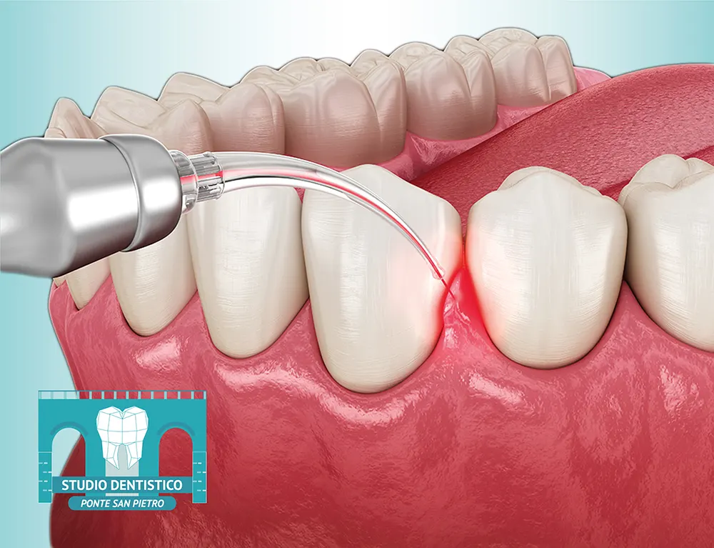 Laser dentale: guida alla cura di gengive infiammate e parodontite